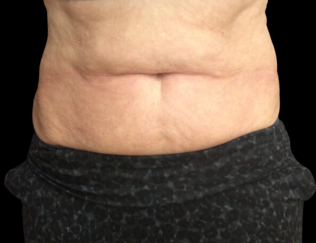 CoolSculpting® - Target Stubborn Fat & Contour Your Body | GraceMed