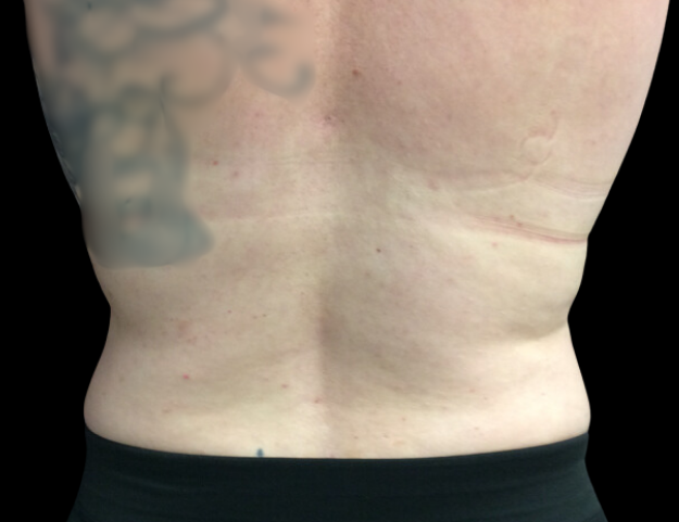 CoolSculpting® - Target Stubborn Fat & Contour Your Body | GraceMed