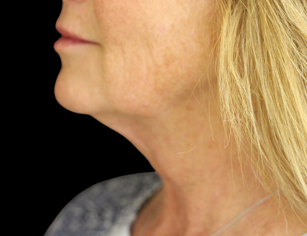 CoolSculpting® - Target Stubborn Fat & Contour Your Body | GraceMed