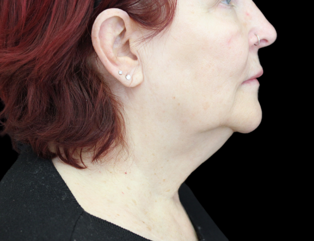 CoolSculpting® - Target Stubborn Fat & Contour Your Body | GraceMed