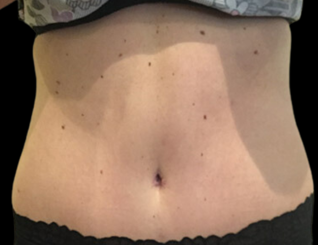 Tummy Tuck Surgery - Transform Your Silhouette and Boost Confidence ...