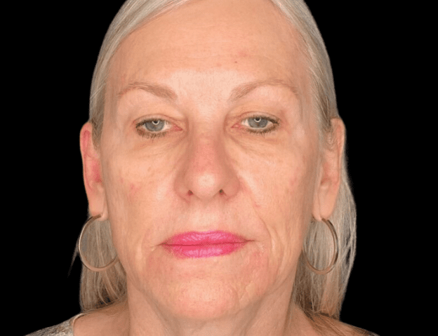 EXION® Face & Neck - Advanced Skin Firming & Tightening | GraceMed