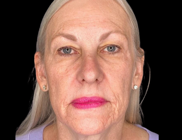 EXION® Face & Neck - Advanced Skin Firming & Tightening | GraceMed